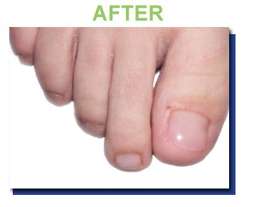 No More Ugly Toenails! – Clark Podiatry Center